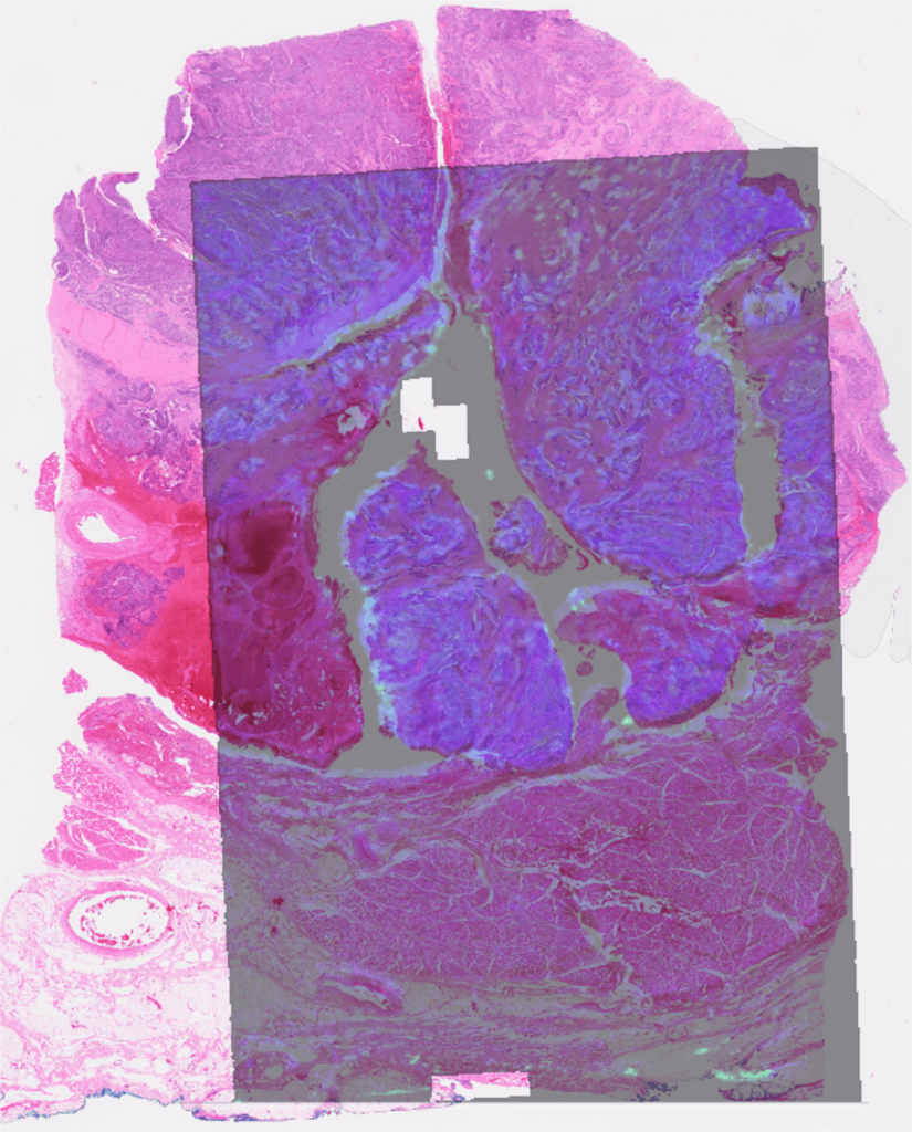 AI-Driven Precision Pathology Meets Spatial Biology