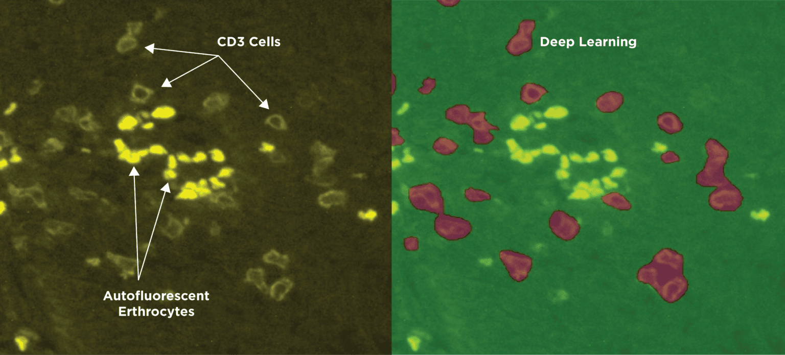 AI-Driven Precision Pathology Meets Spatial Biology
