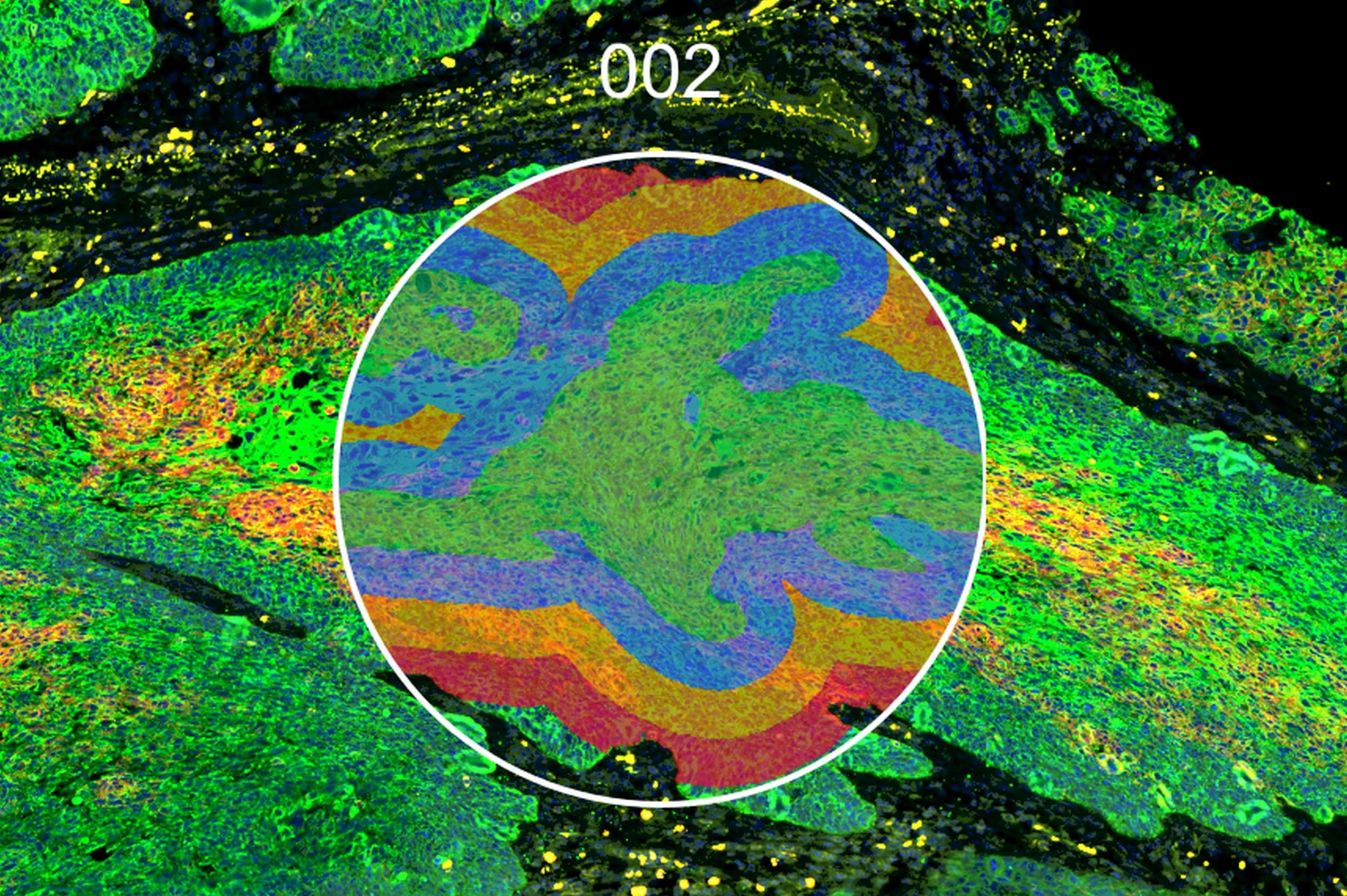 AI-Driven Precision Pathology Meets Spatial Biology